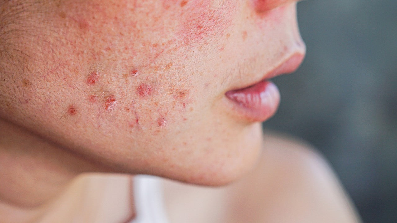 Acne treatment with natural cosmetics - avoid these errors! | Flow ...